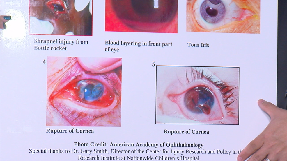 Majority of emergency visits for firework injuries are for the eyes | WKRC